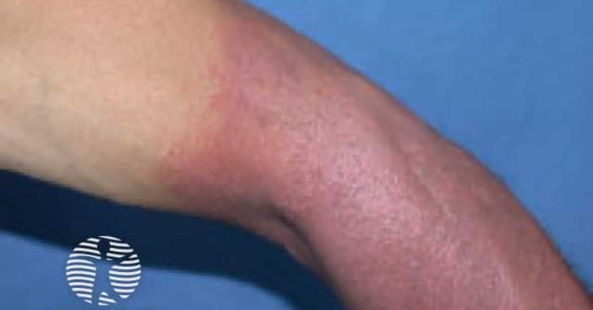 DermNet® - photosensitivity3 s image