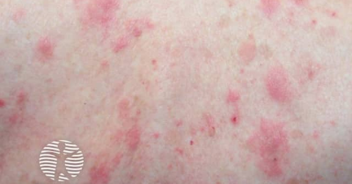 Pre-bullous pemphigoid urticated plaques image