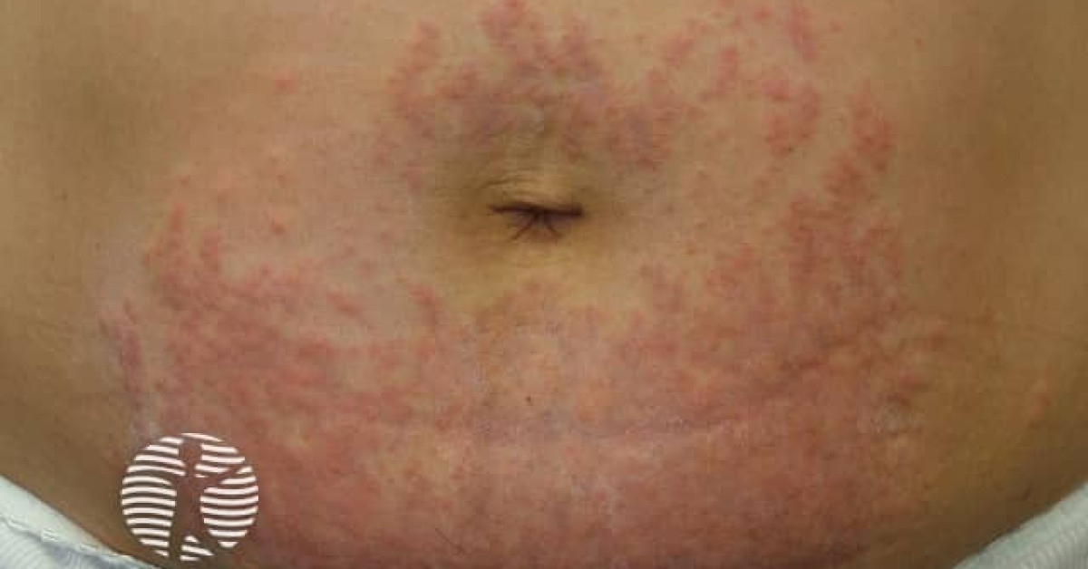 Pruritic Urticarial Papules And Plaques Of Pregnancy Image