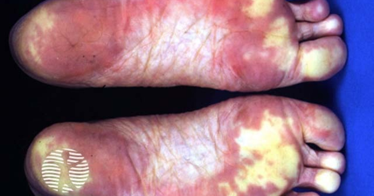 Raynaud Phenomenon Image