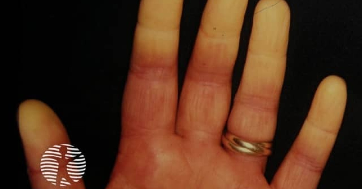 Raynaud phenomenon image
