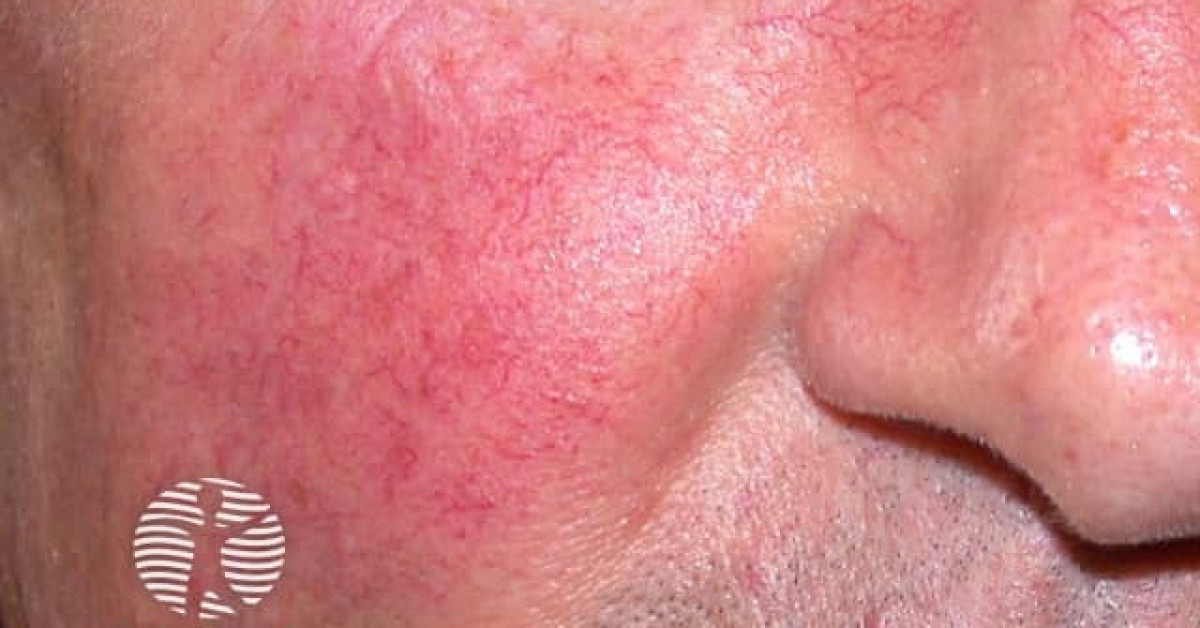 Facial redness image