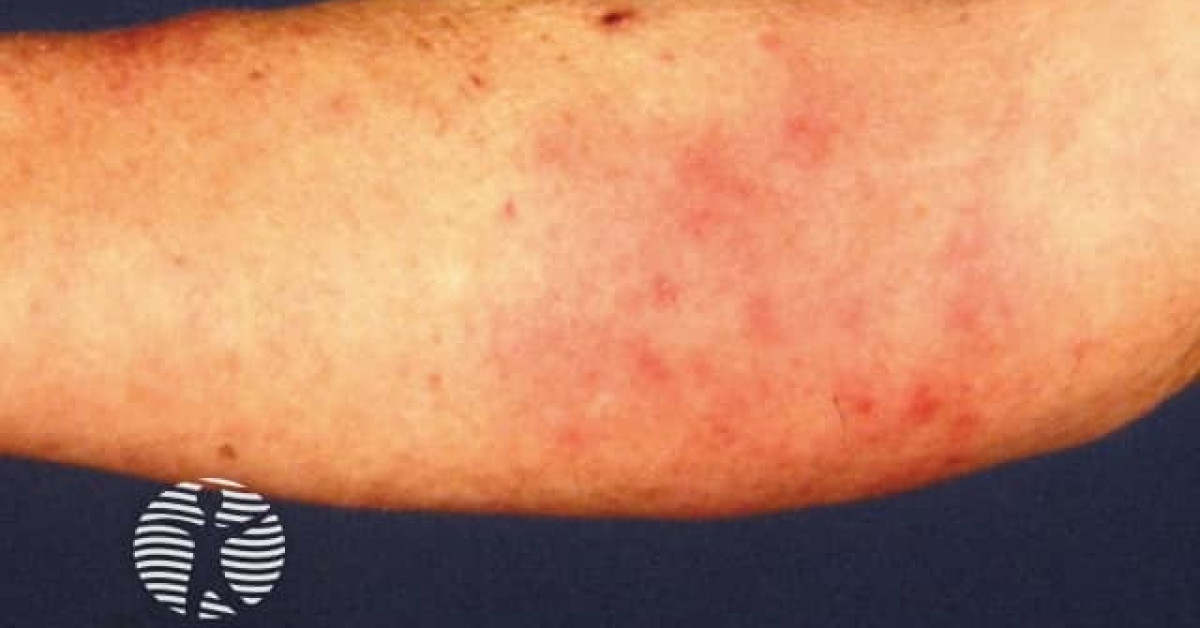 Neutrophilic dermatosis associated with rheumatoid arthritis image