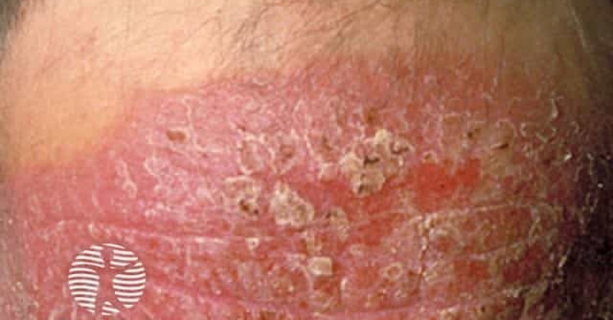 Chronic actinic dermatitis image