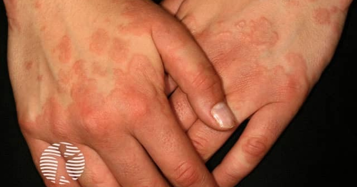 Target lesions image