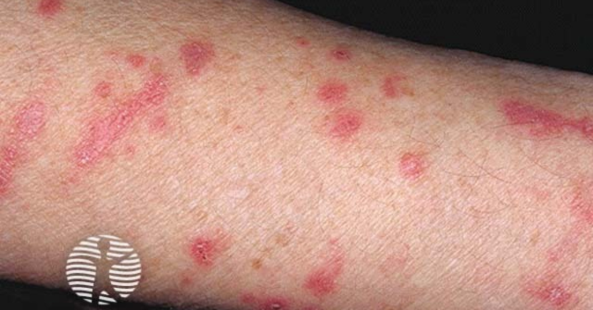 Plant contact dermatitis image