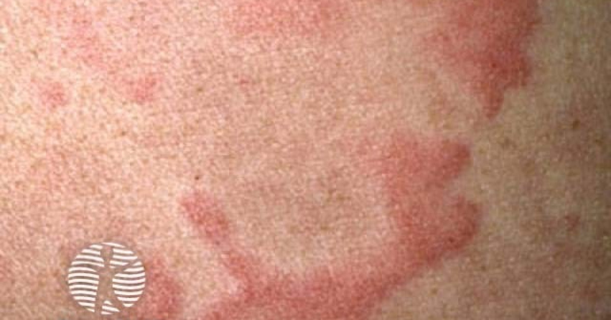 Urticaria image