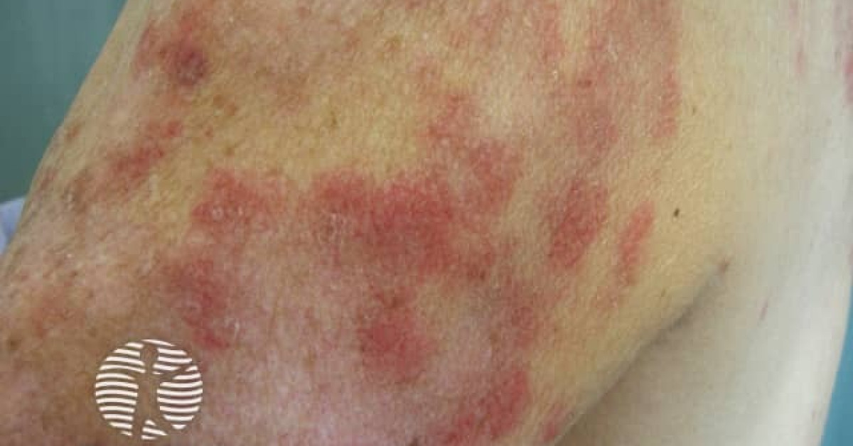 Drug-induced subacute lupus erythematosus image