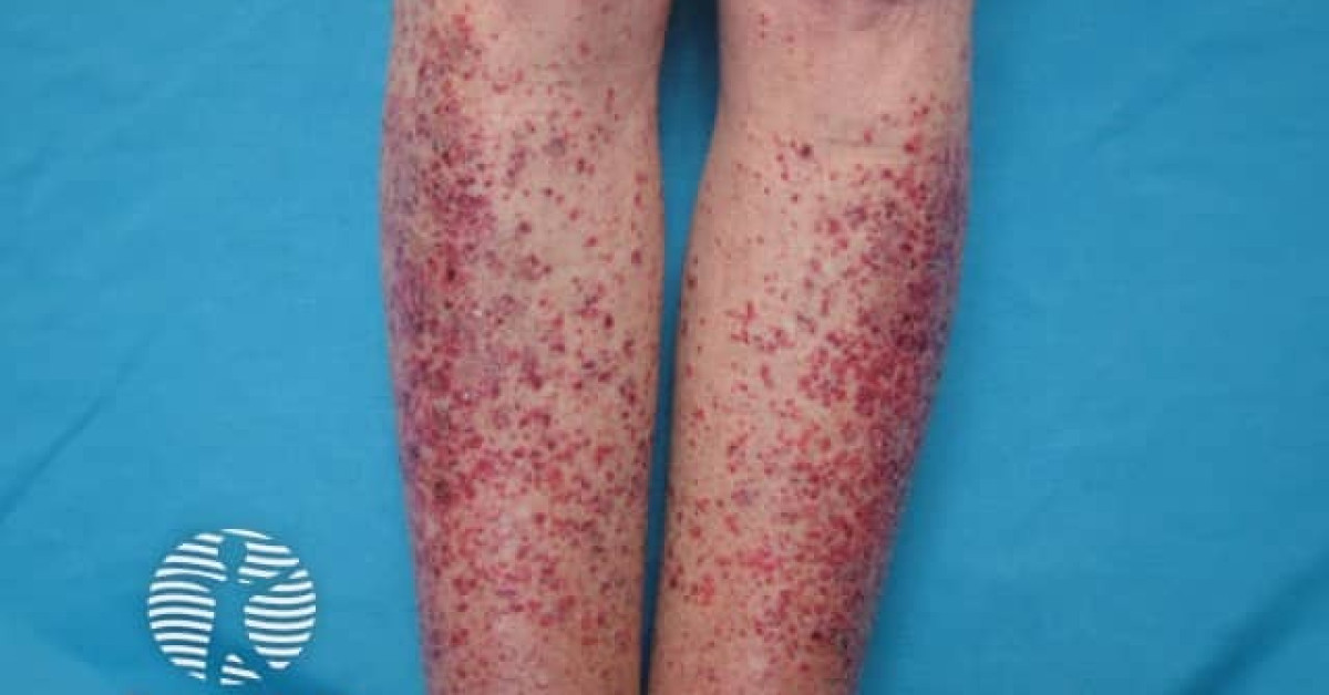 Hypersensitivity vasculitis image