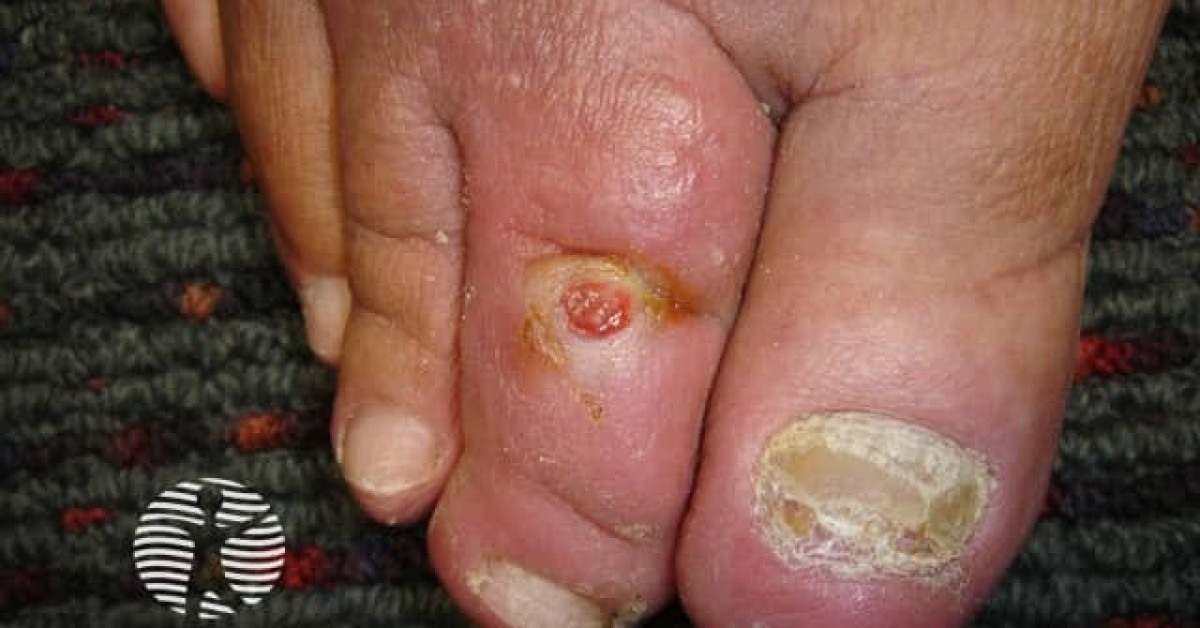 Smoking and its effects on the skin image