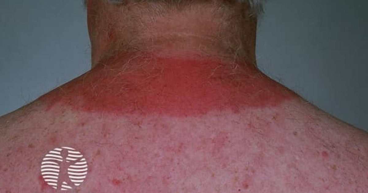 Solar urticaria image