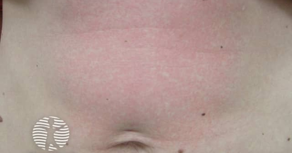Solar urticaria provoked experimentally image