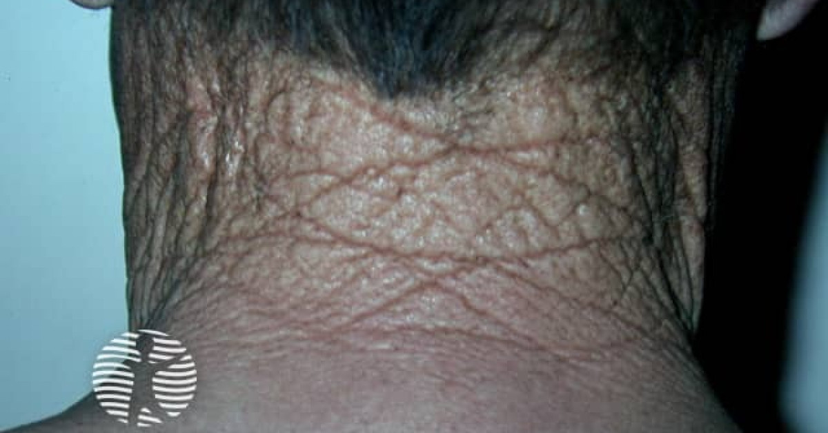 Favre-Racouchot syndrome image