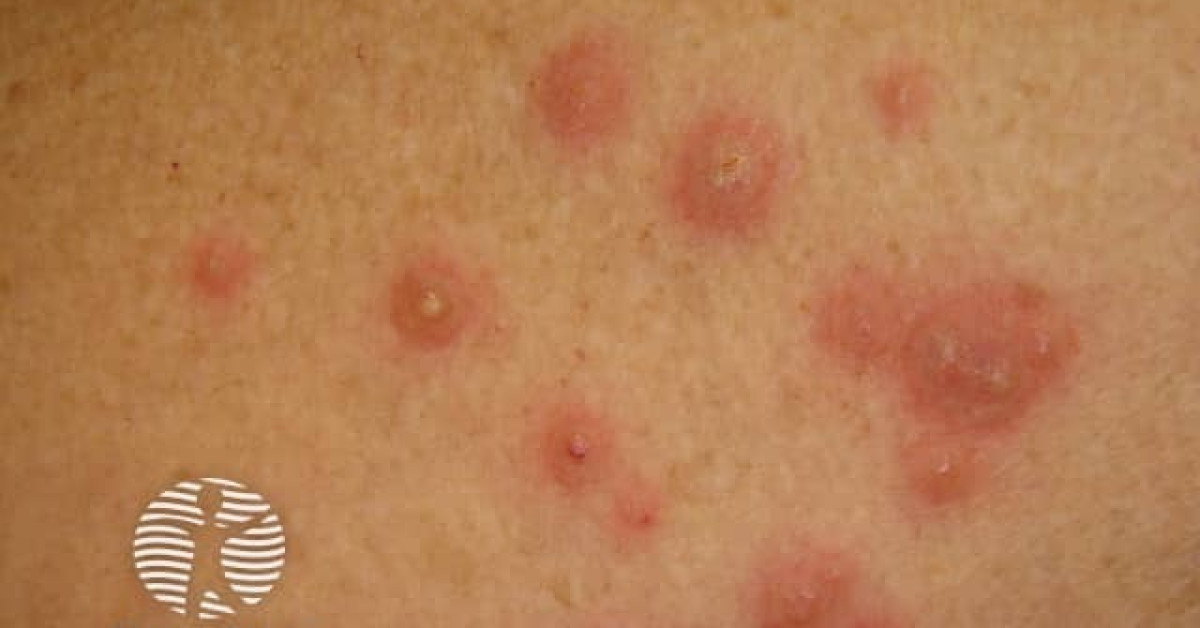 Sweet syndrome image