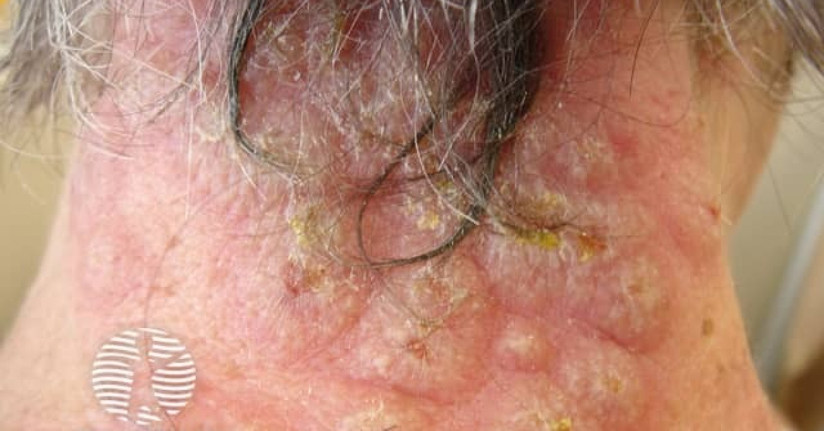 Acute Neutrophilic Dermatosis Image
