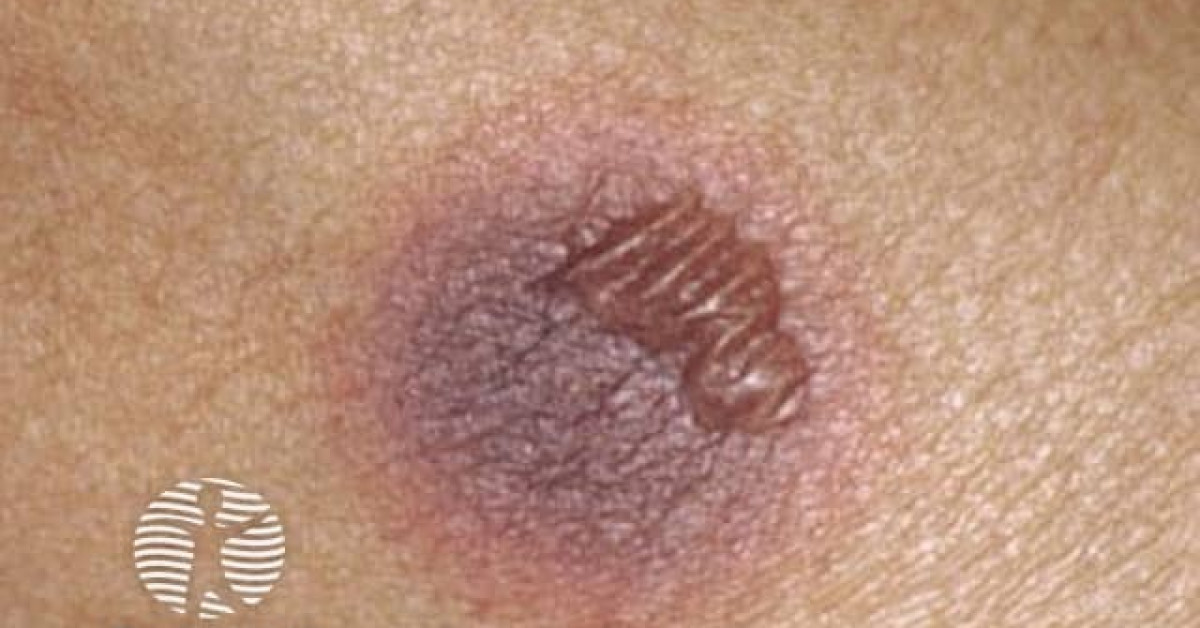 Targetoid lesion in fixed drug eruption image