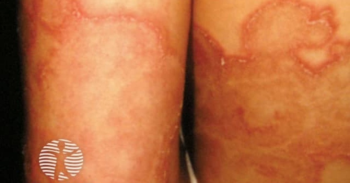 Targetoid lesion in erythema annulare centrifugum image