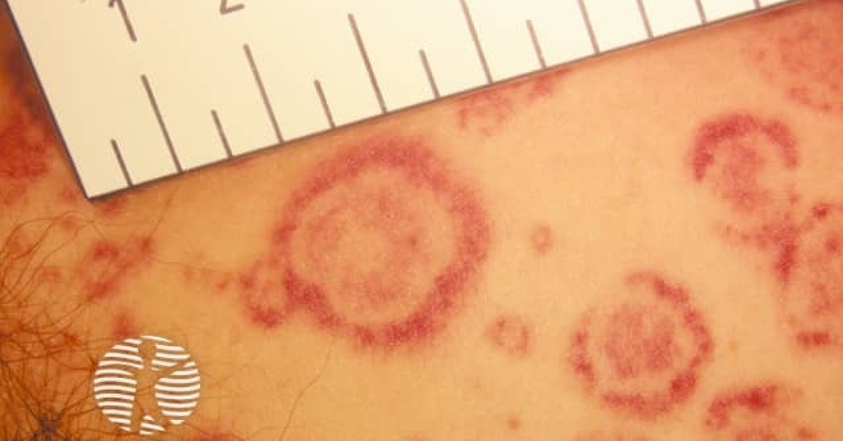 Targetoid lesion in urticarial vasculitis image