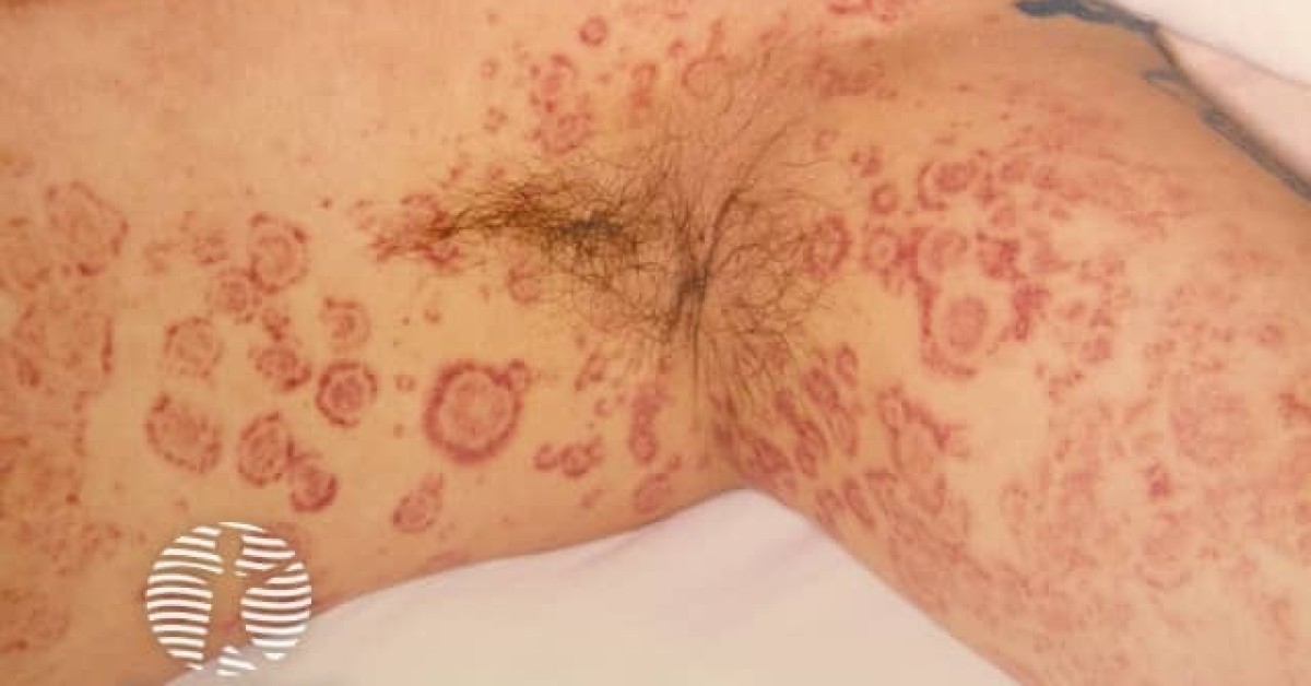 Targetoid lesion in urticarial vasculitis image