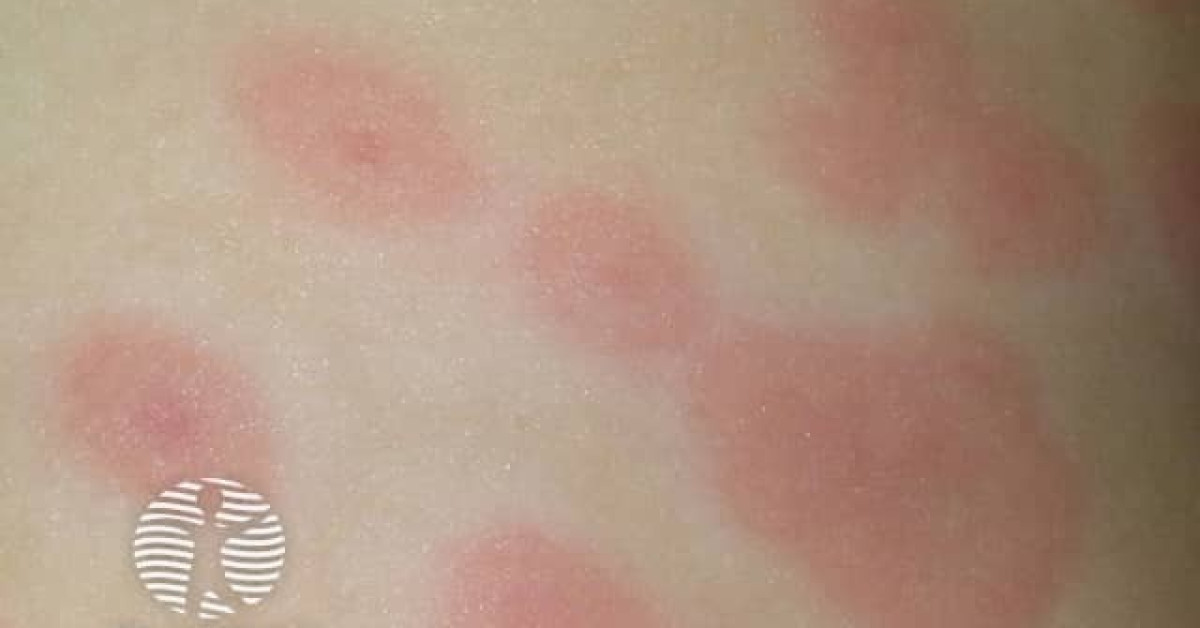 Targetoid lesion in Finkelstein vasculitis image