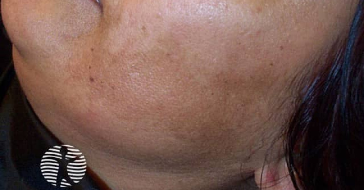 Skin phototype 4 image