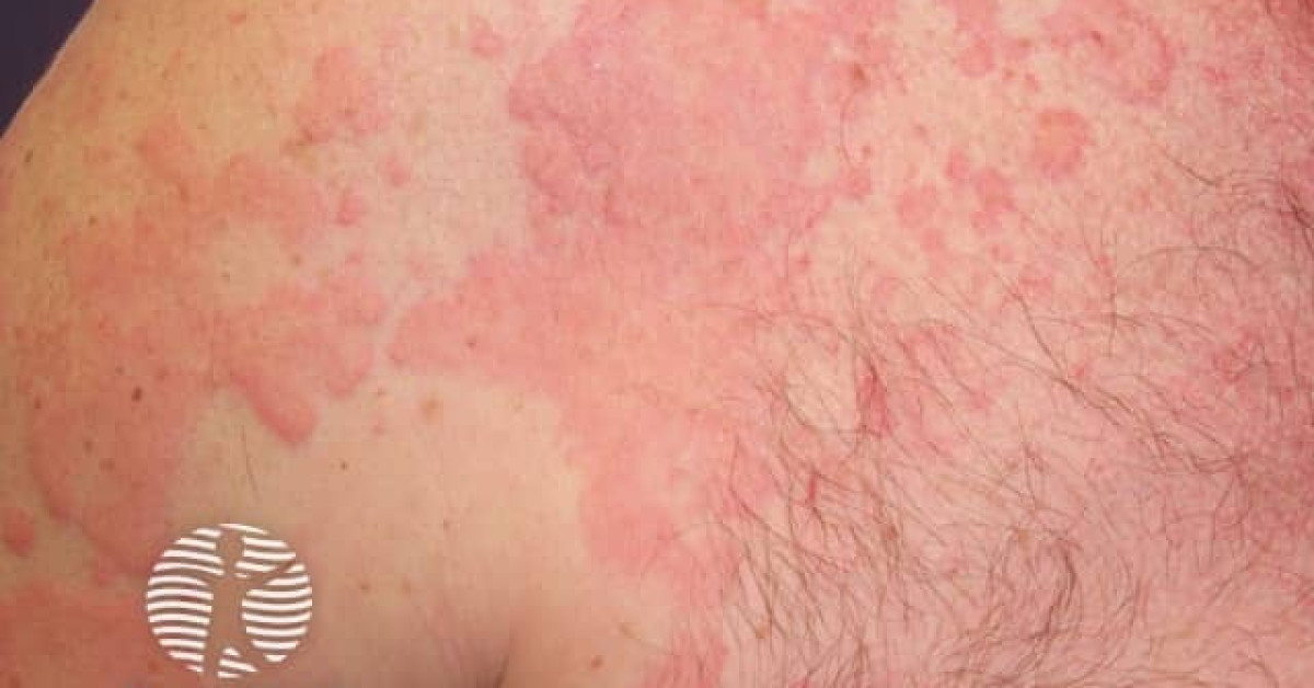Urticaria from nonsteroidal anti-inflammatory drug image