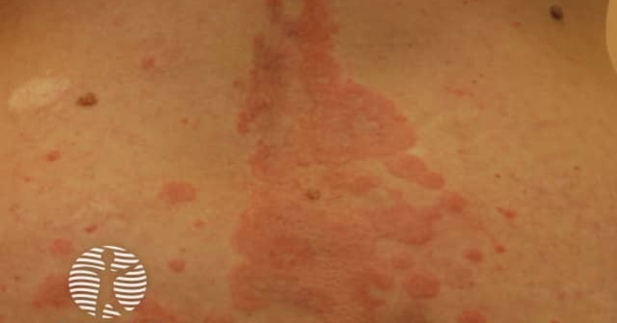 Urticaria image