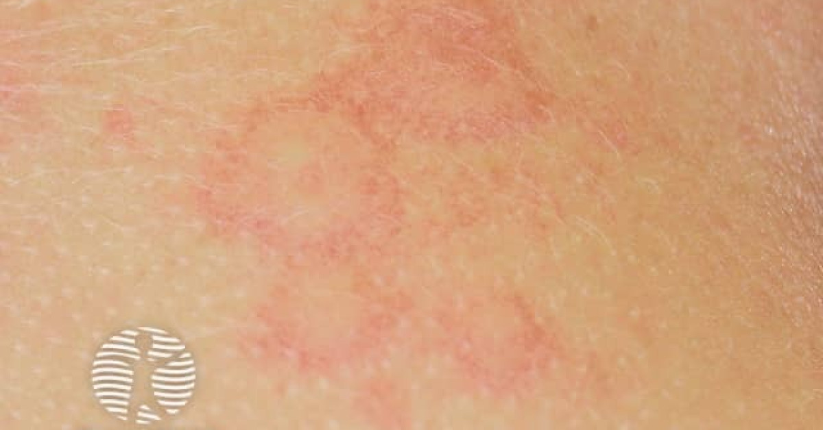 Urticaria image