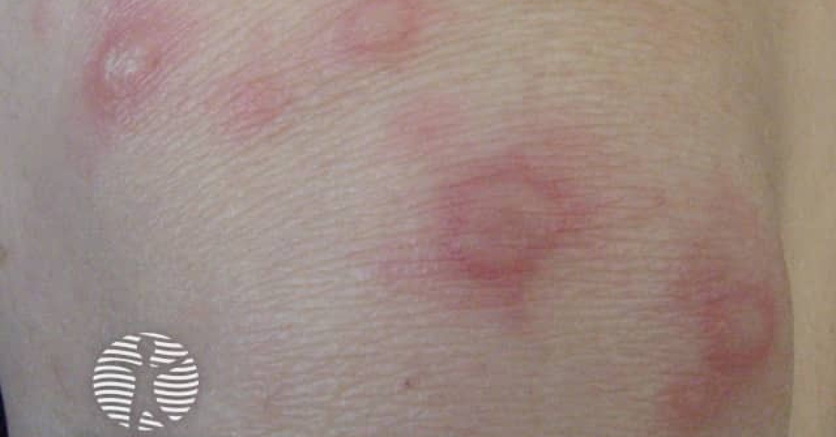 Urticaria image