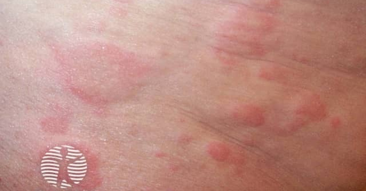 Urticaria image