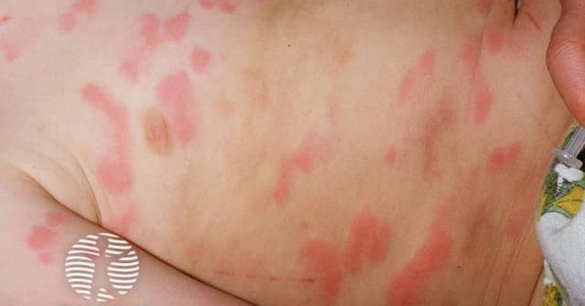Urticaria image
