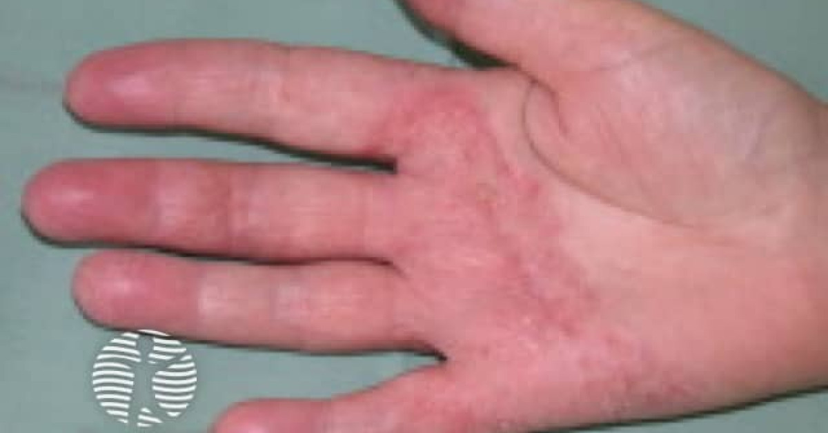 vesicular hand dermatitis s image