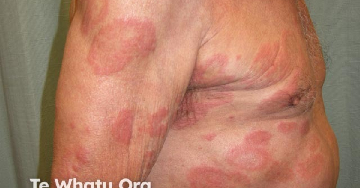 Annular erythema image