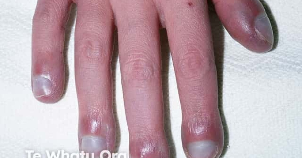Clubbing of the nails image