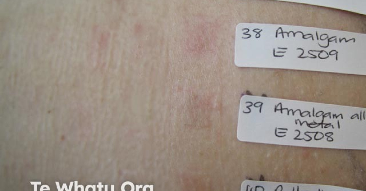 Borderline multiple patch tests in a dentist image