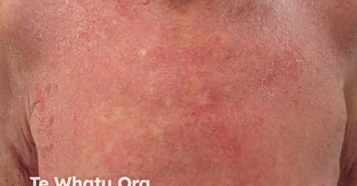Erythroderma image