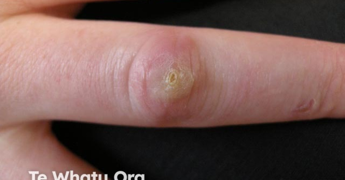 Infected hand injury image