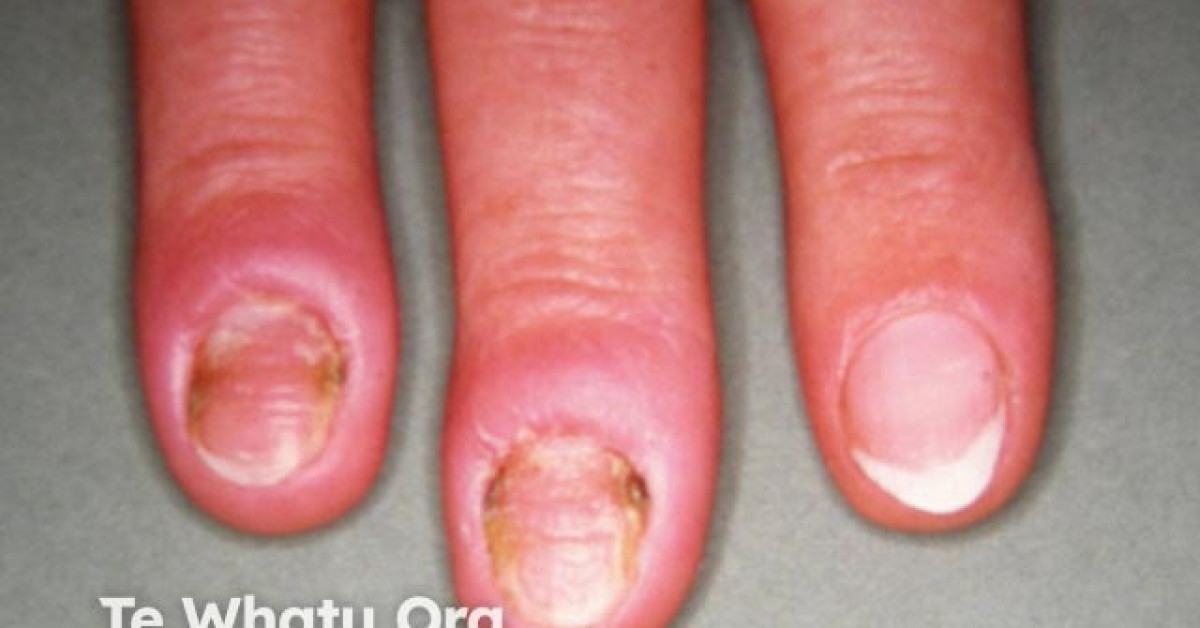 Chronic paronychia image