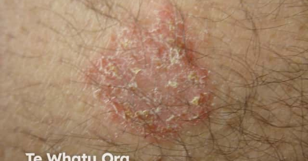 Nummular dermatitis image