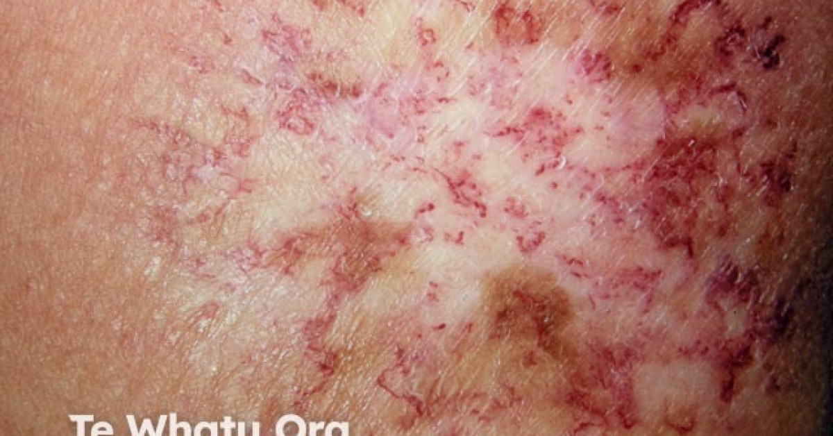 Chronic radiation dermatitis image