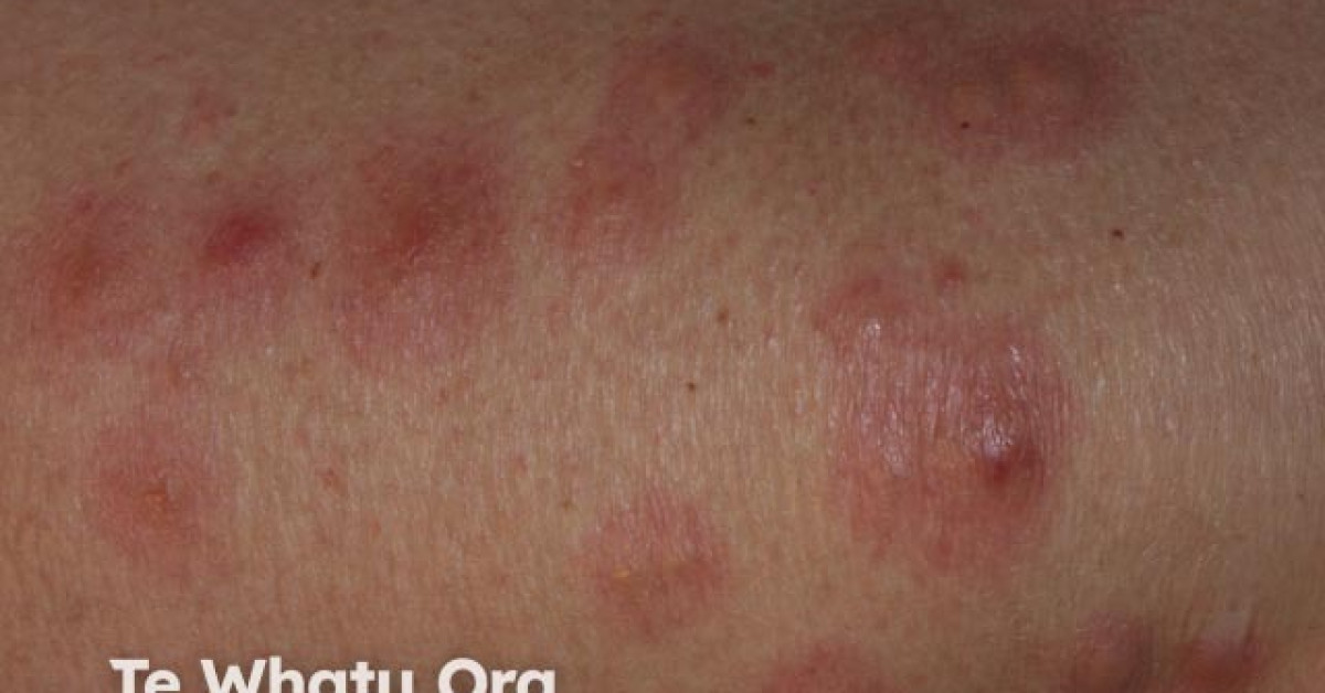 Sweet disease image