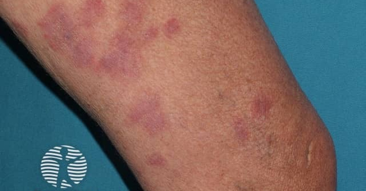 DermNet® - Sweet disease image