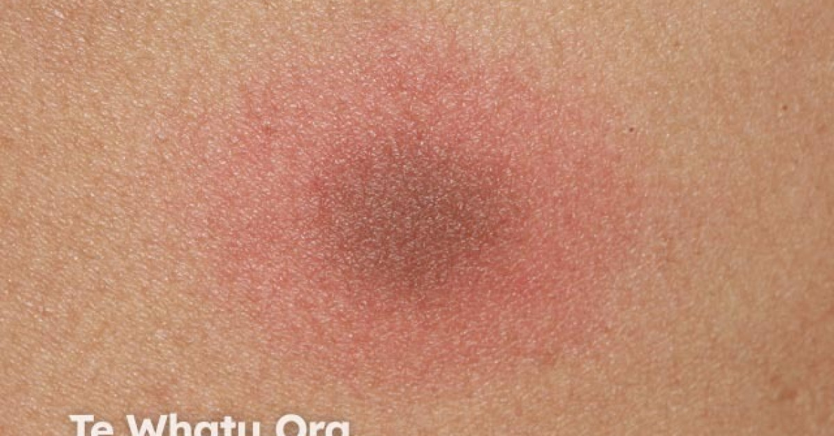 Targetoid lesion in fixed drug eruption image