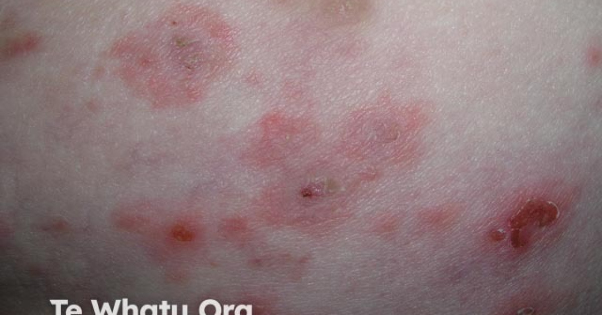 Targetoid lesion in bullous pemphigoid image