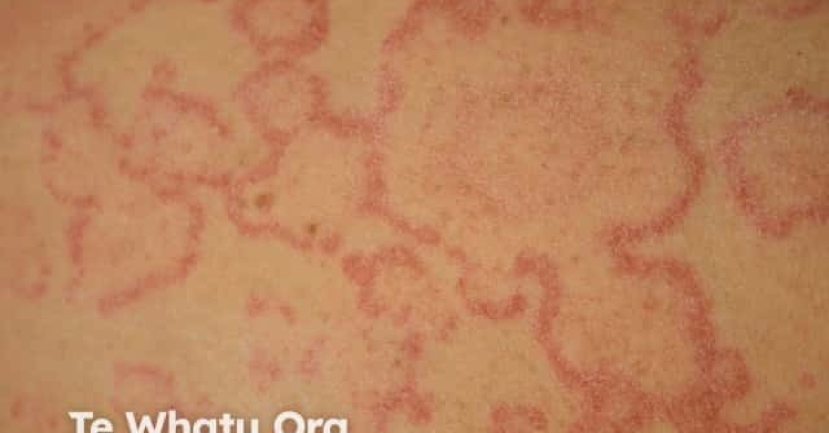 Targetoid lesion in urticaria image
