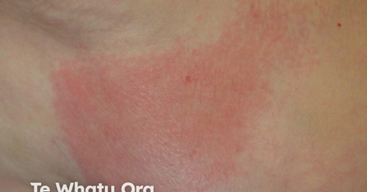 Urticarial dermatitis image