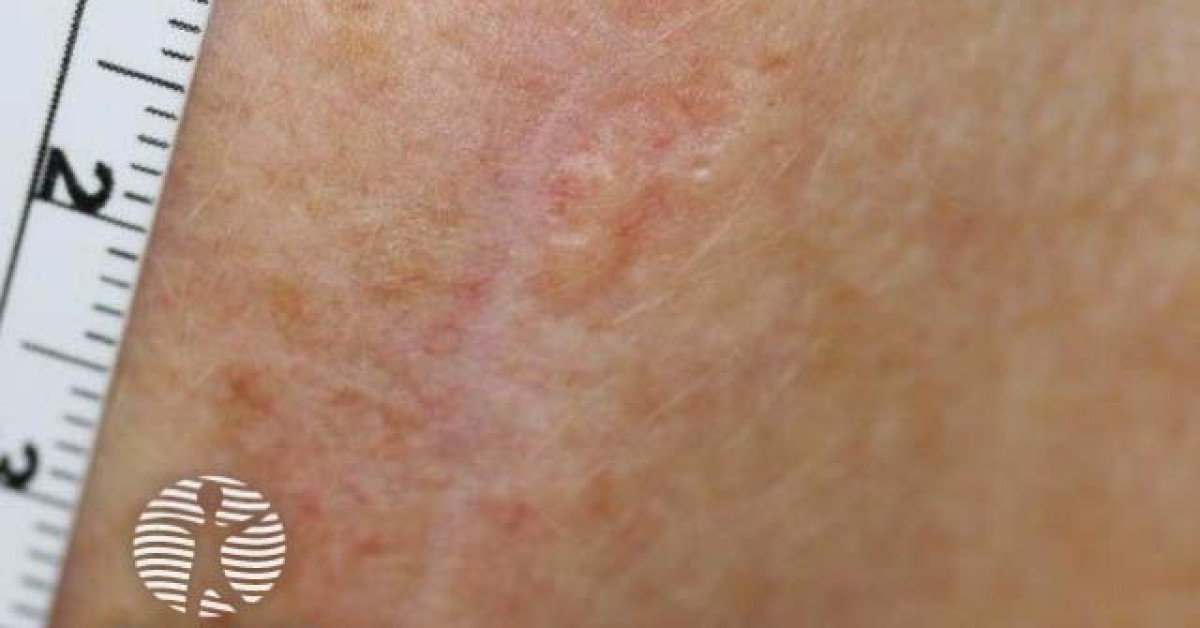 Recurrent basal cell carcinoma suitable for Mohs image