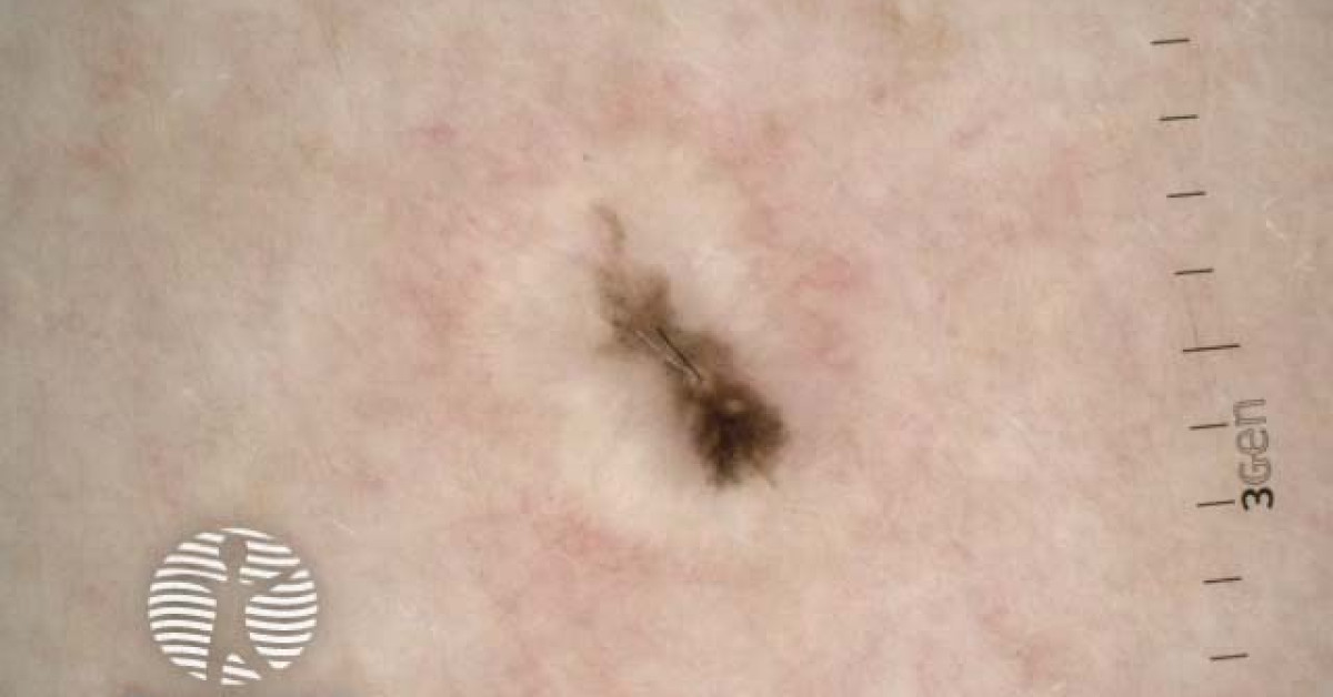 Recurrent naevus dermoscopy image