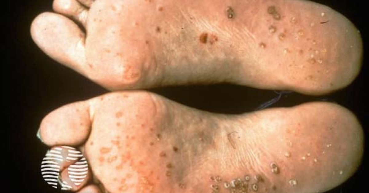 Reiter syndrome image