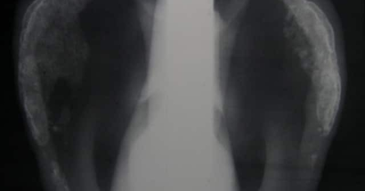 Xray of auricular relapsing polychondritis image